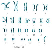 aneuploidia in "Dizionario di Medicina"