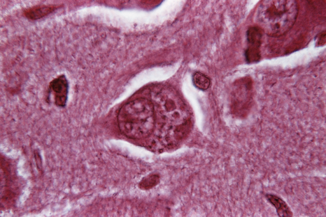 Pick, Arnold in "Dizionario di Medicina"