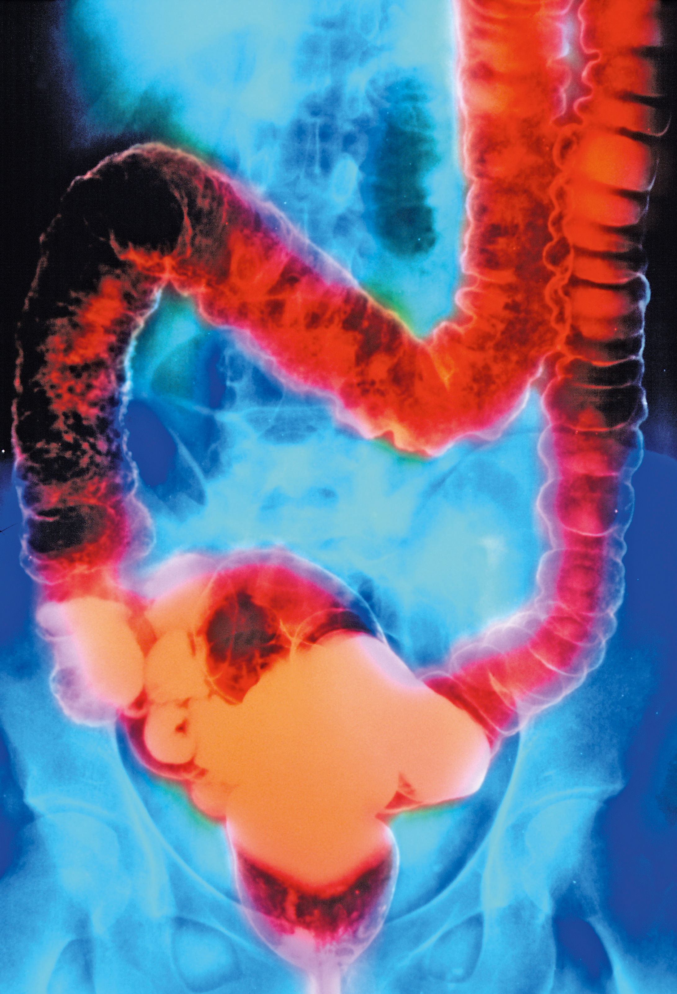 colite in "Dizionario di Medicina"