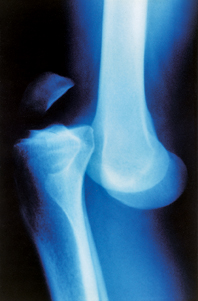 lussazione in "Dizionario di Medicina"