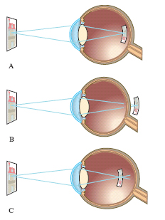 ametropia nell'Enciclopedia Treccani