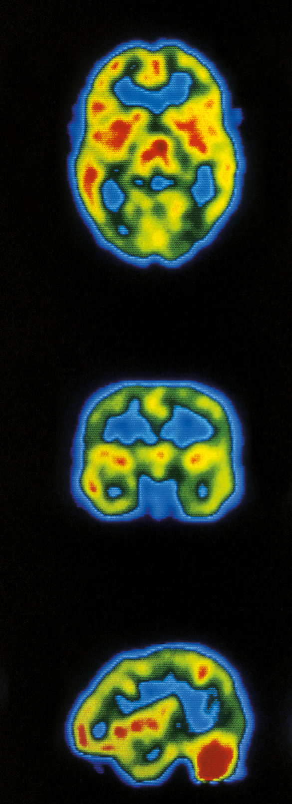 SPECT (sigla dell'ingl. Single Photon Emission Computerized Tomography ...